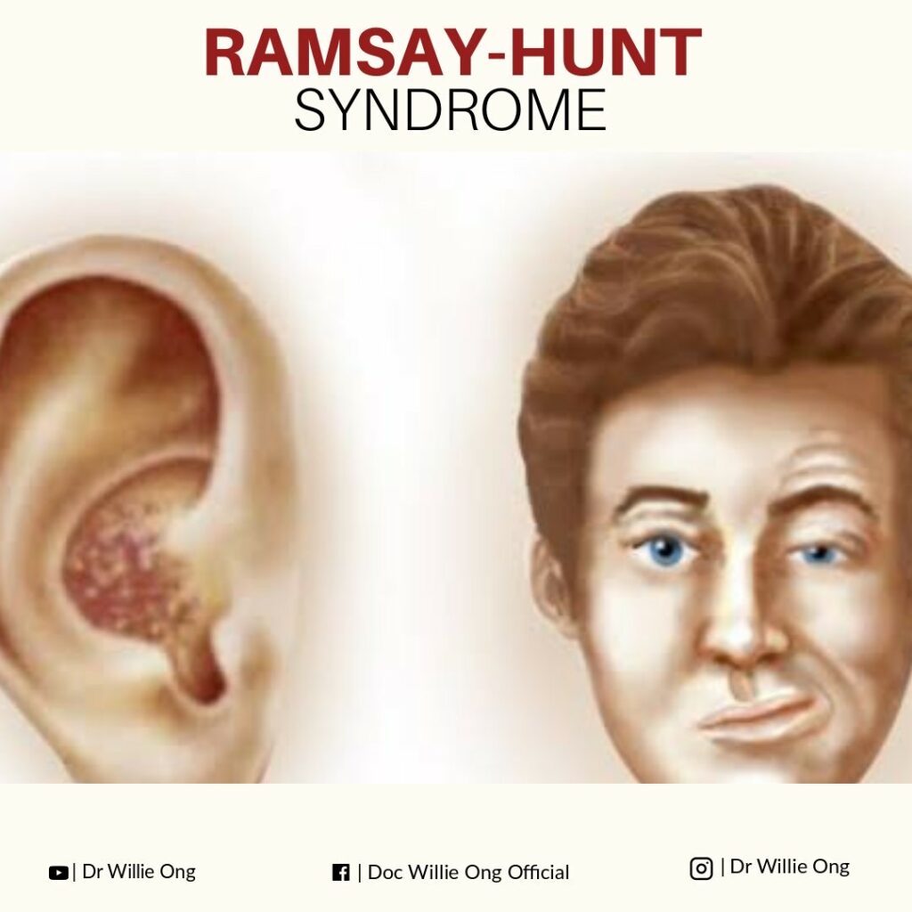 What Is Ramsay Hunt Syndrome RHS Facial Paralysis Doc Willie Ong What Is Ramsay Hunt Syndrome RHS Facial Paralysis Doc Willie Ong