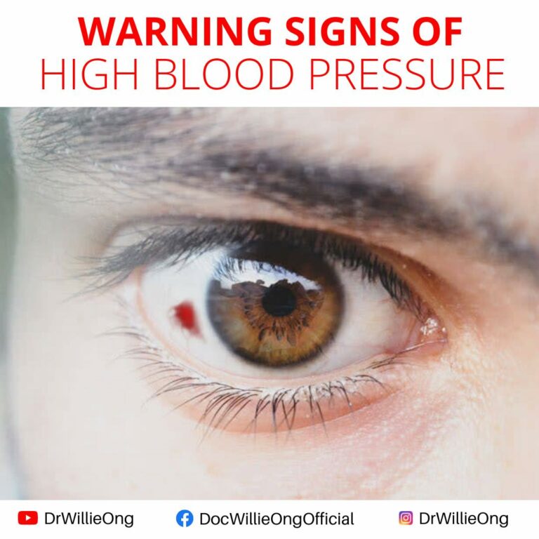 Warning Signs of High Blood Pressure - Doc Willie Ong